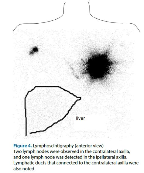The Management Of Contralateral Axillary Sentinel Lymph Nodes Detected By Lymphoscintigraphy In