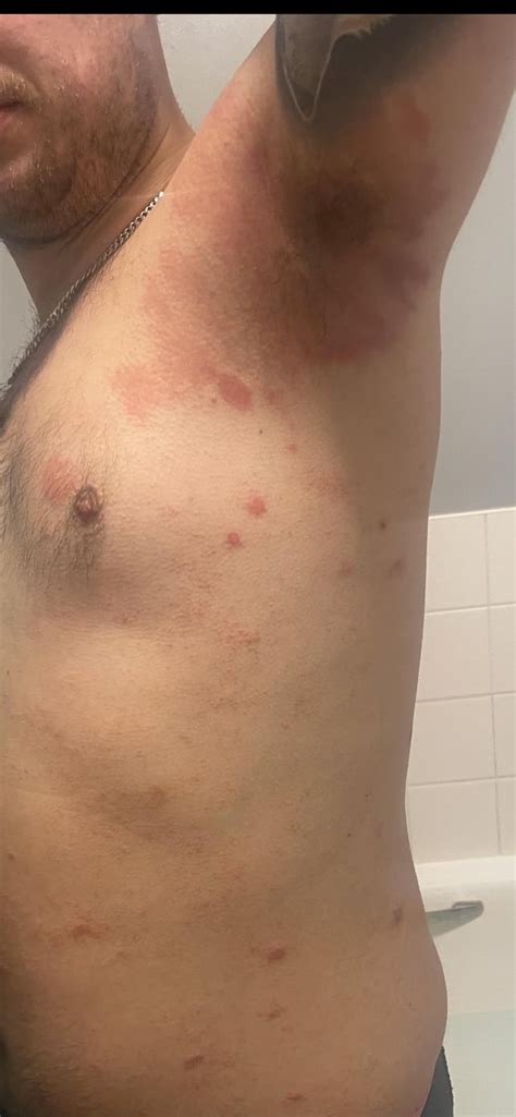 Armpit Rash Rdermatologyquestions