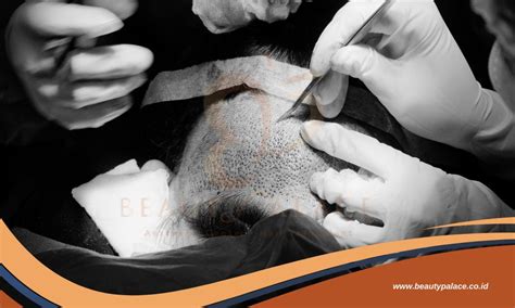 Efek Samping Hair Transplant