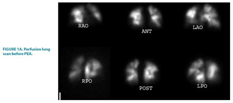 Nuclear Medicine Lung Perfusion Scan Nuclear Medicine