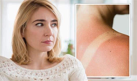 Sunburn Four Important Ways To Treat Red And Sore Skin Medical