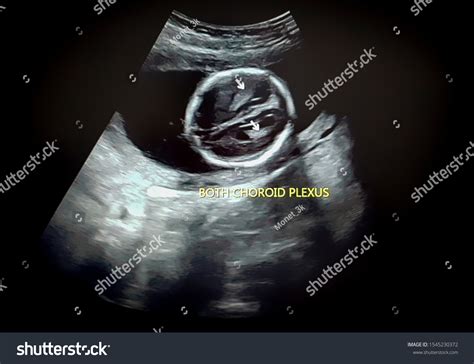 Ultrasound Fetal Choroid Plexus Stock Photo Edit Now 1545230372