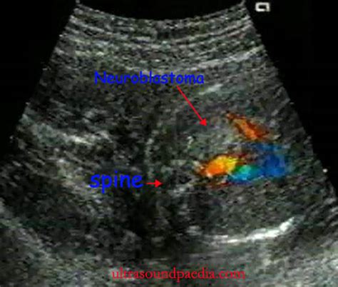 Neuroblastoma Ultrasound Fetal