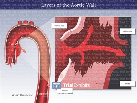 Layers Of The Aortic Wall Trial Exhibits Inc