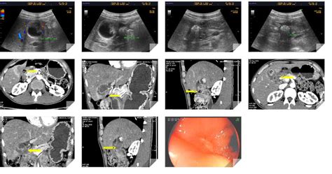 Vietnamese Medic Ultrasound Case 392 Perforated Seal Off Duodenum Dr LÊ TỰ PhÚc Dr Phan Thanh