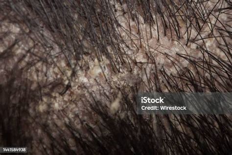 비듬 지루성 피부염을 가진 머리 뿌리 또는 두피의 매크로 보기 기름기 있는에 대한 스톡 사진 및 기타 이미지 기름기 있는 털 피부염 Istock