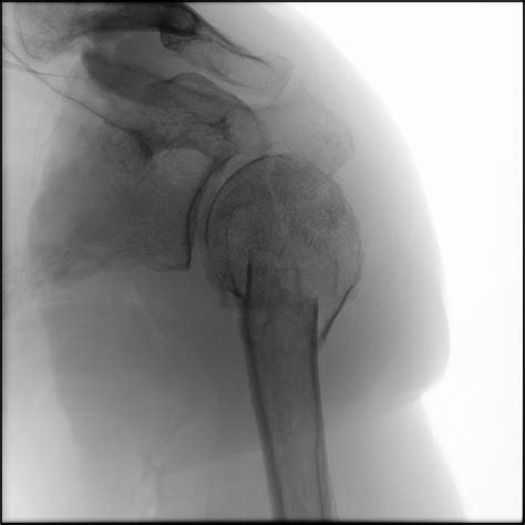 Preview Fracture Of Proximal Humerus Left