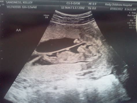 Team Sandness 12 Week Ultrasound Nuchal Translucency Nt Scan