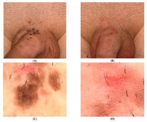 Correlations Between Histopathological And Confocal Reflectance Microscopy Aspects In A Patient