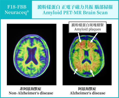 Amyloid Pet Scan For Diagnosing Alzheimers Disease 聖德肋撒醫院 掃描部 St Teresas Hospital