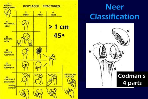 Ppt Proximal Humerus Powerpoint Presentation Free Download Id2939338 Ppt Proximal Humerus Powerpoint Presentation Free Download Id2939338