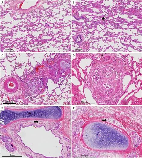 《radiology》发表我国学者最新研究：bmpr2突变相关肺动脉高压患者的影像学特征 头条 呼吸界