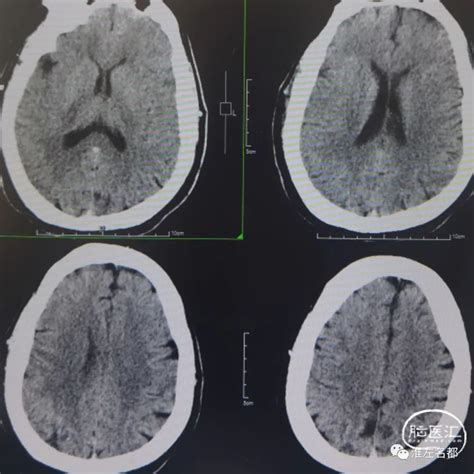 脑血管影像案例（38）：心脏室壁瘤伴血栓形成所致栓塞性脑梗死 脑医汇
