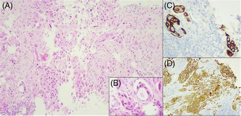 Cell Block Of The Cervical Lymph Node Biopsy A Neoplasm With Solid Download Scientific