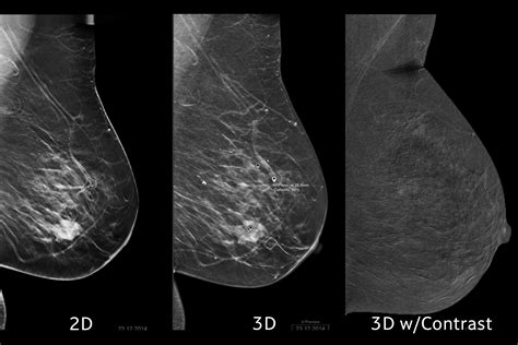 3d Digital Mammograms