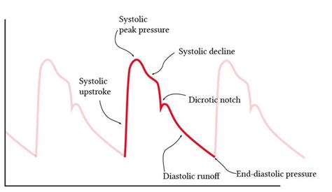 Normal Arterial Line Waveforms Deranged Physiology Icu Nursing