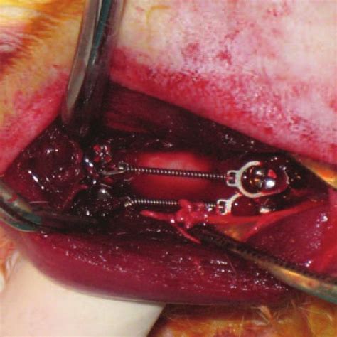 Prescription In MBT Technique Download Table