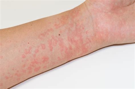Skin Allergies — Riversdale Dermatology