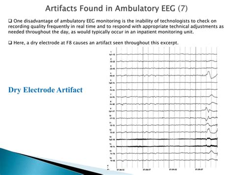 Artifact Removal From Ambulatory Eeg Pptx