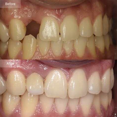 Dental Implants Before And After Images