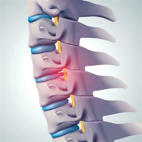 Herniated Disc Vector Art Icons And Graphics For Free Download