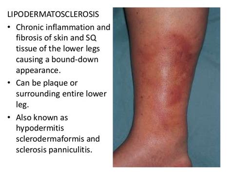 Skin Manifestations Of Scleroderma By Dr Lorinda Chung Md