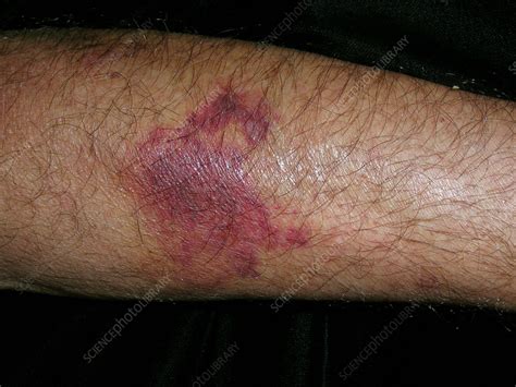 Senile Purpura Stock Image C056 2670 Science Photo Library