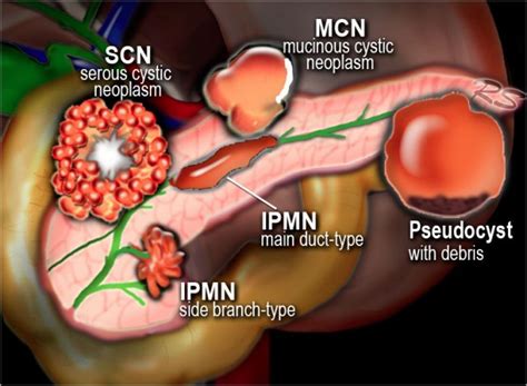 The Radiology Assistant Pancreatic Cystic Lesions