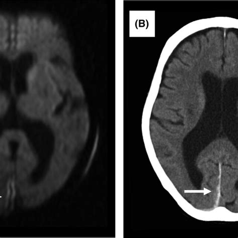 Imaging Features Of The Right Occipital Region A Diffusion‐weighted