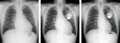 Chest X Ray A Before Crt B Four Years After Standard Crt C Nine Download Scientific
