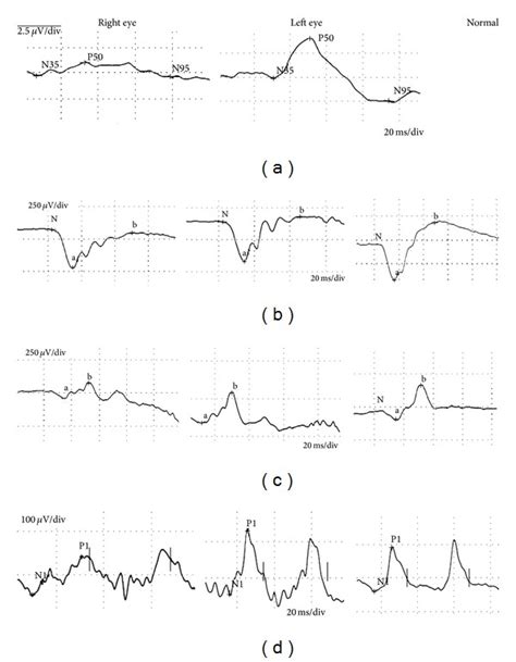 A Pattern Electroretinogram Perg Showing Reduction Of The P50 Download Scientific Diagram