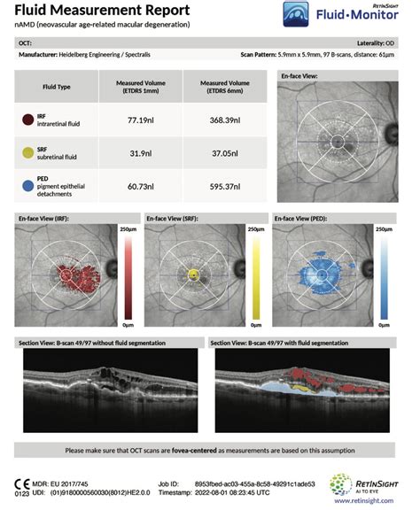 The Ophthalmologist Uncover Secure Access To Ai Analytics With Heidelberg Appway