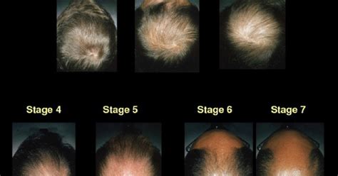 Sinclair Classification Of Male Pattern Alopecia Image Sinclair Classification Of Male Pattern Alopecia Image