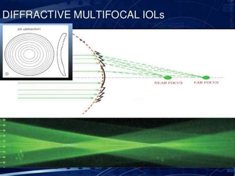 Types Of Iol Pptx Types Of Iol Pptx