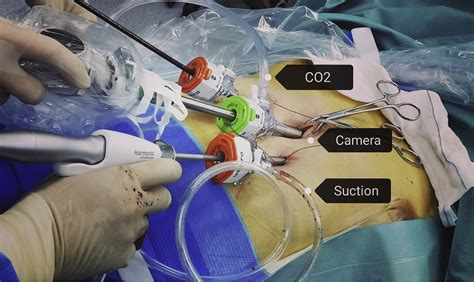 Subxiphoid Versus Unilateral Video Assisted Thoracoscopic Surgery