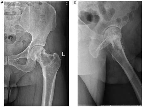 A Orthogonal And B Lateral X Ray Of The Left Hip Joint X Ray