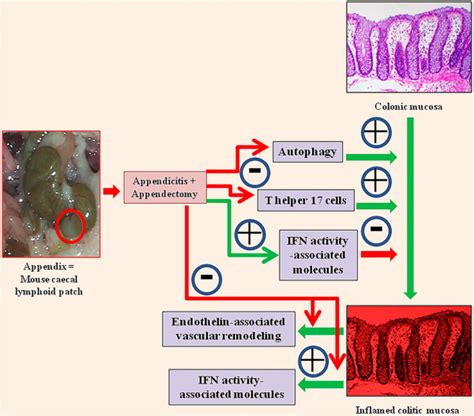 A Novel Model Of Appendicitis And Appendectomy To Investigate