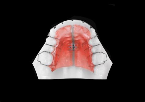 Schwartz Appliance Upper Universal Orthodontic Lab