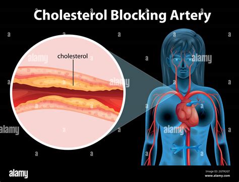 Vein Catheter Stock Vektorgrafiken Kaufen Alamy