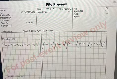 V Fib Converted Rparamedics
