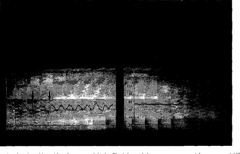 Figure 1 From Temporary Loss Of Cardiac Autonomic Innervation After The Maze Procedure
