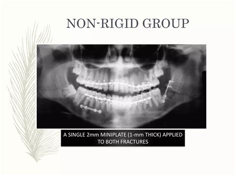Open Reduction And Internal Fixation Of Combined Angle And Body Symphysis Fractures Of The