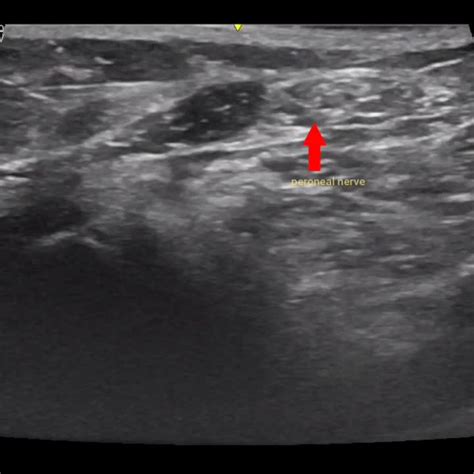 Mehmet Gok On Linkedin Prp Injection Around Peroneal Nerve Ap Approach