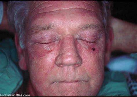 Global Skin Atlas Diagnosis Detail