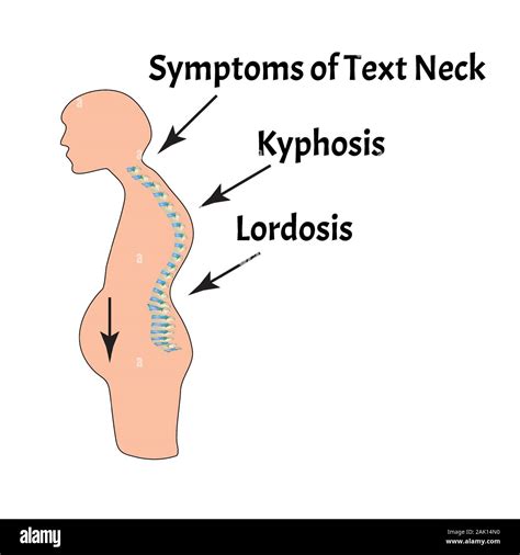 Lordosis Kyphosis Scoliosis