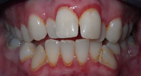 Malocclusion Of Teeth Symptoms And Causes La Dental Clinic