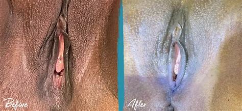 Vaginal Rejuvenation Patient 253015 Before And After Photos Mona