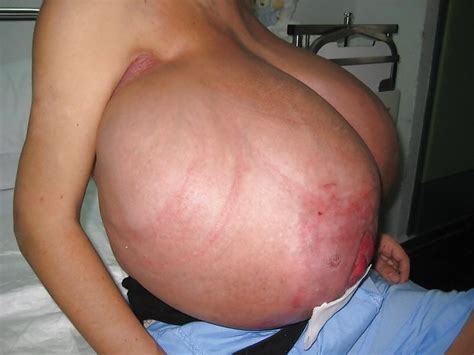 Macromastia 19 Pics Xhamster