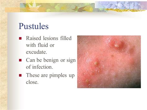 Rashes And The School Nurse Ppt Download