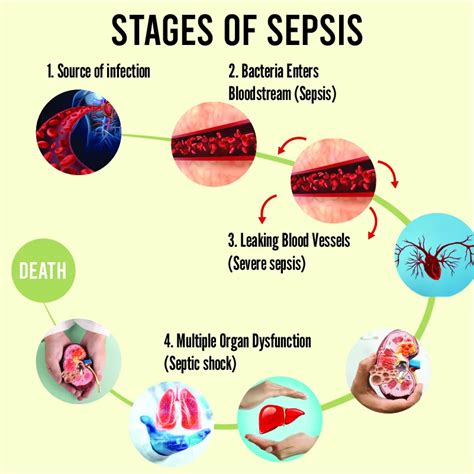 Sepsis Signs And Symptoms Does Your Receptionist Recognise Signs Of